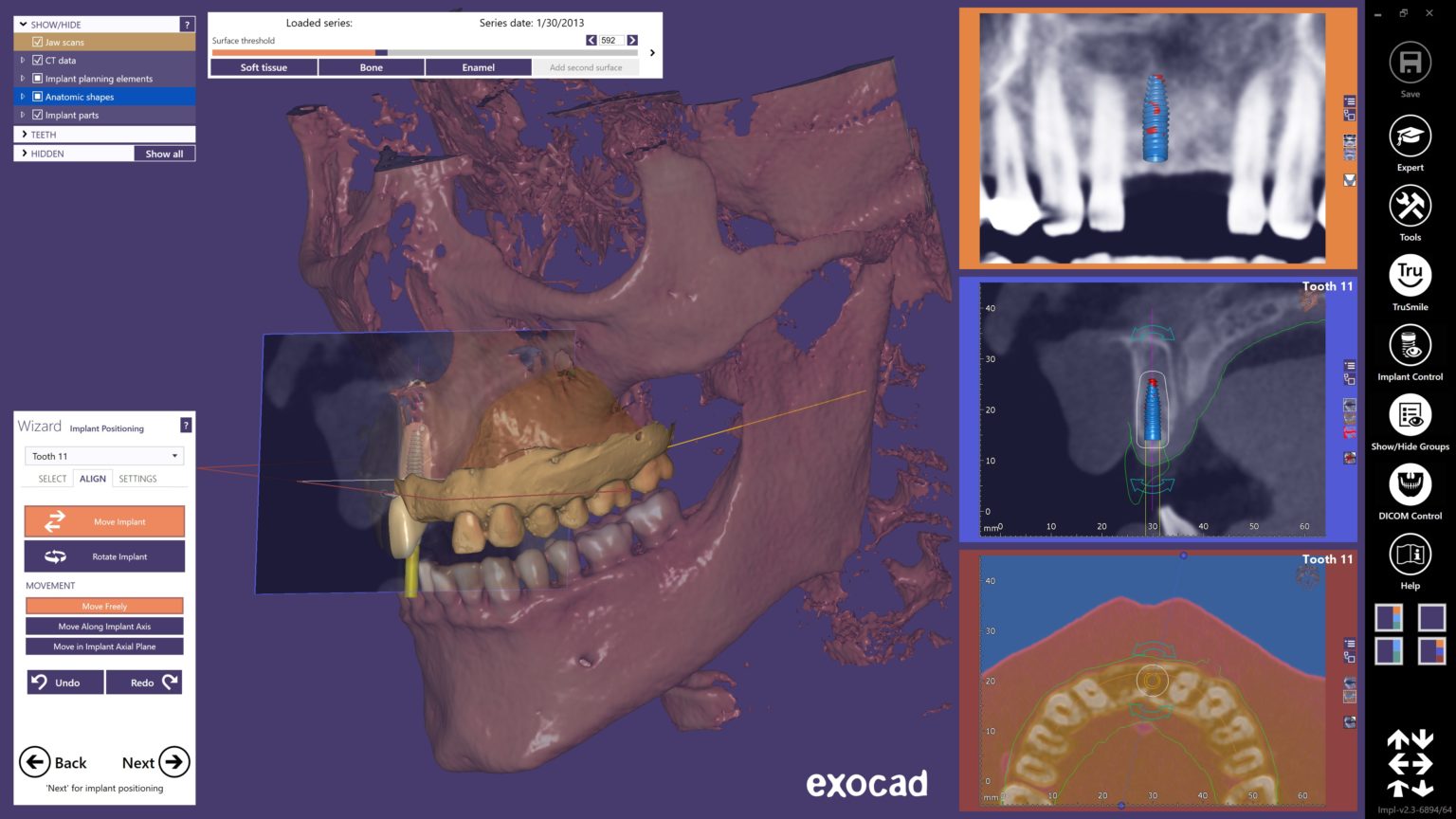 Exoplan by Exocad | Implant Planning and Surgical Guide Software