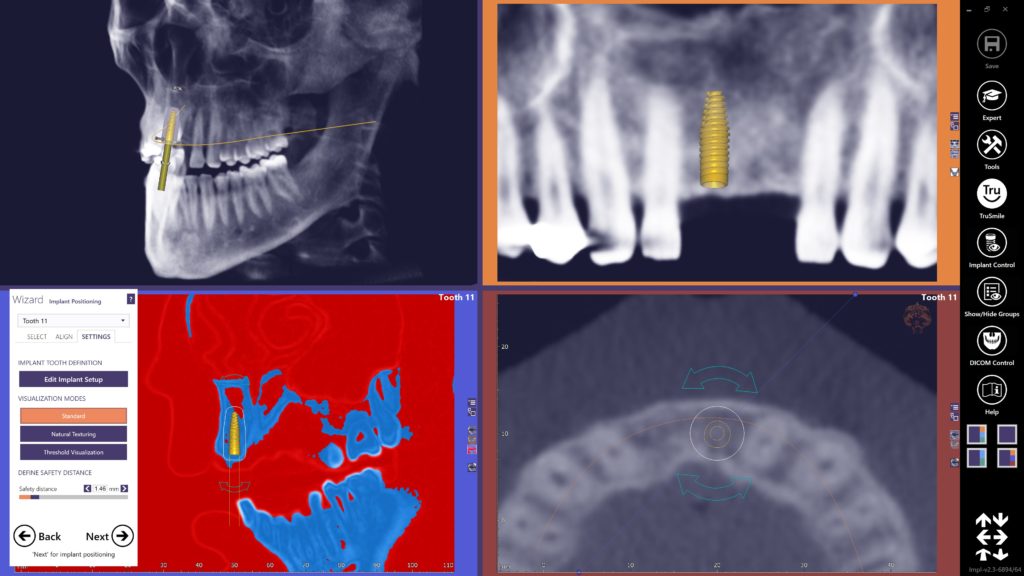 Exoplan by Exocad | Implant Planning and Surgical Guide Software