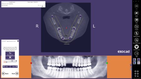 Exoplan by Exocad | Implant Planning and Surgical Guide Software