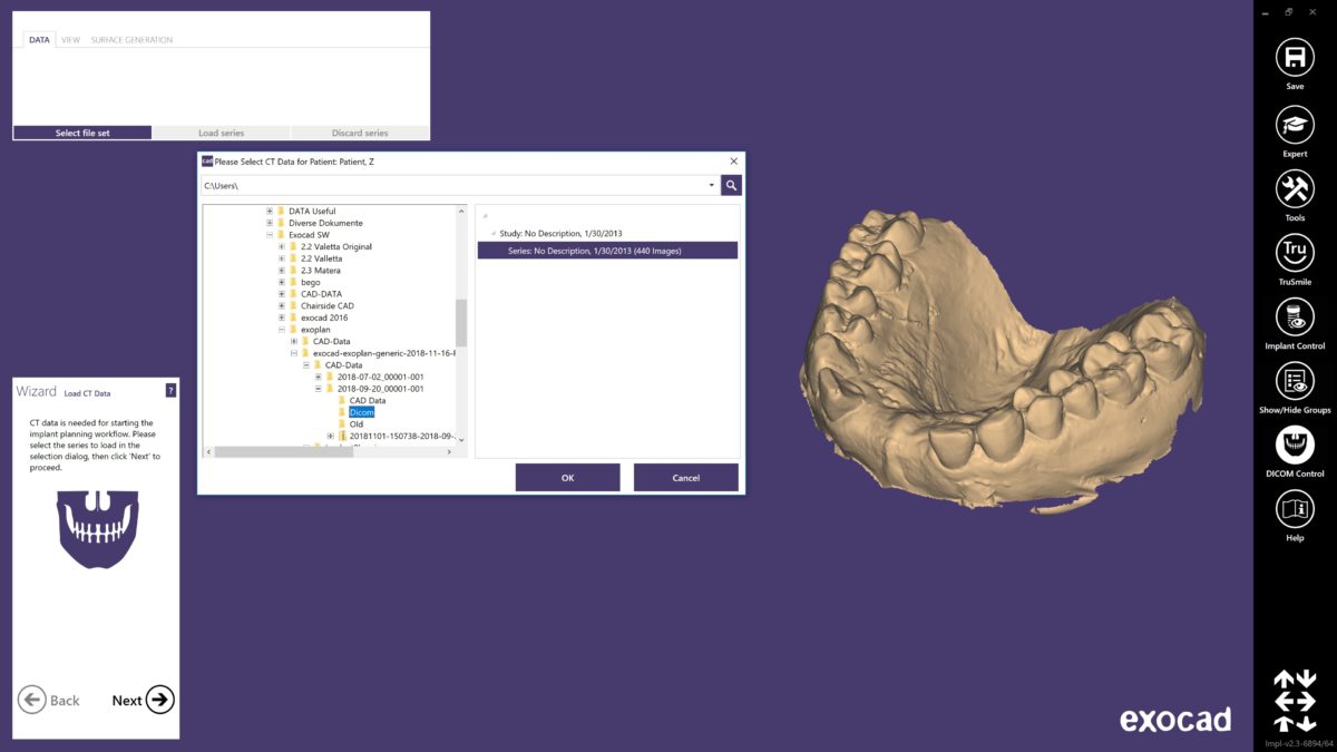 Exoplan by Exocad | Implant Planning and Surgical Guide Software