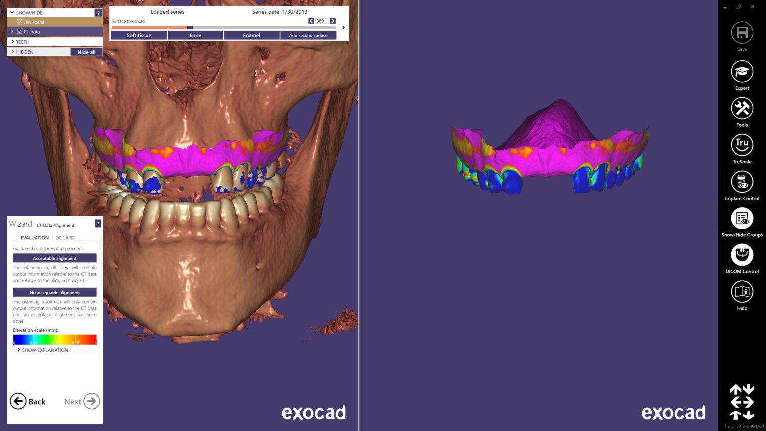 Exoplan by Exocad | Implant Planning and Surgical Guide Software