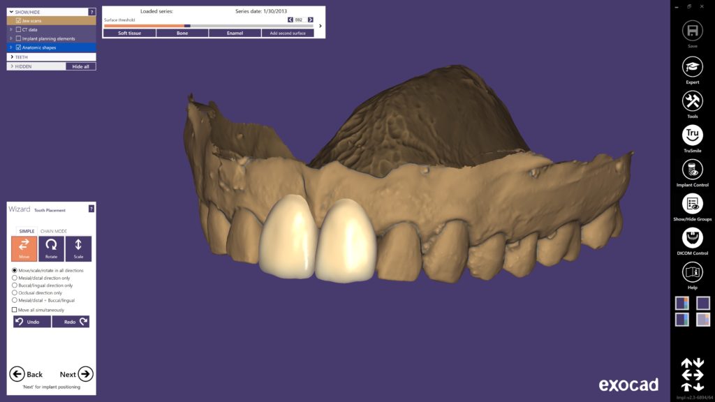 Exoplan by Exocad | Implant Planning and Surgical Guide Software